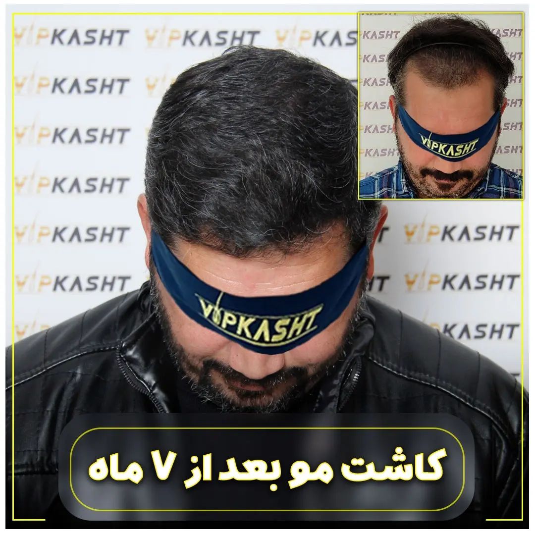 دستگاه کاشت مو پیشرفته کلینیک کاشت مو Vip کلینیک Vipkasht وی آی